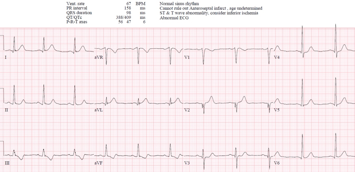 Hyperacute T waves and Occlusion MI | ECG Cases| Emergency Medicine Cases