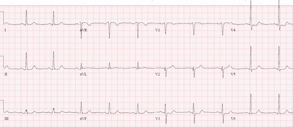 Hyperacute T waves and Occlusion MI | ECG Cases| Emergency Medicine Cases