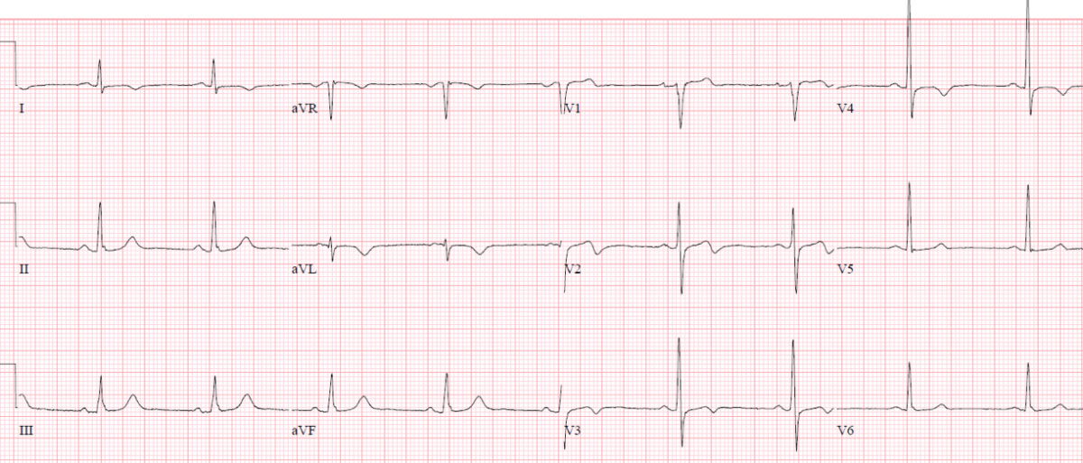 Hyperacute T waves and Occlusion MI | ECG Cases| Emergency Medicine Cases