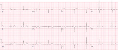 Hyperacute T waves and Occlusion MI | ECG Cases| Emergency Medicine Cases