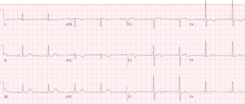 Hyperacute T waves and Occlusion MI | ECG Cases| Emergency Medicine Cases