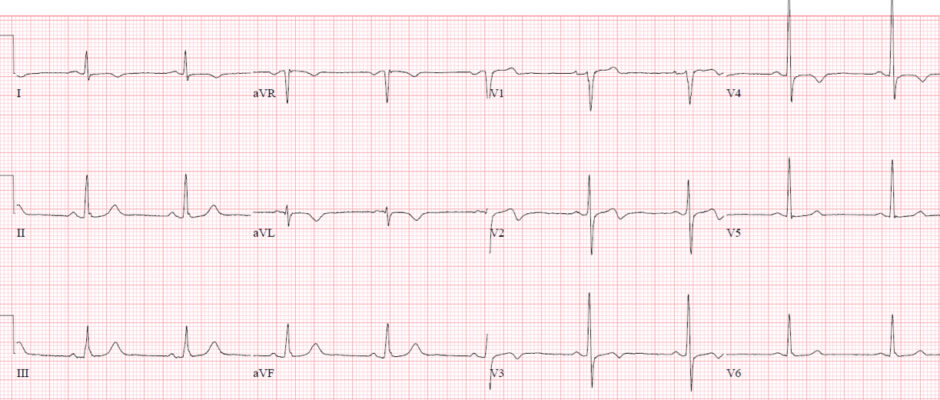 Hyperacute T waves and Occlusion MI | ECG Cases| Emergency Medicine Cases