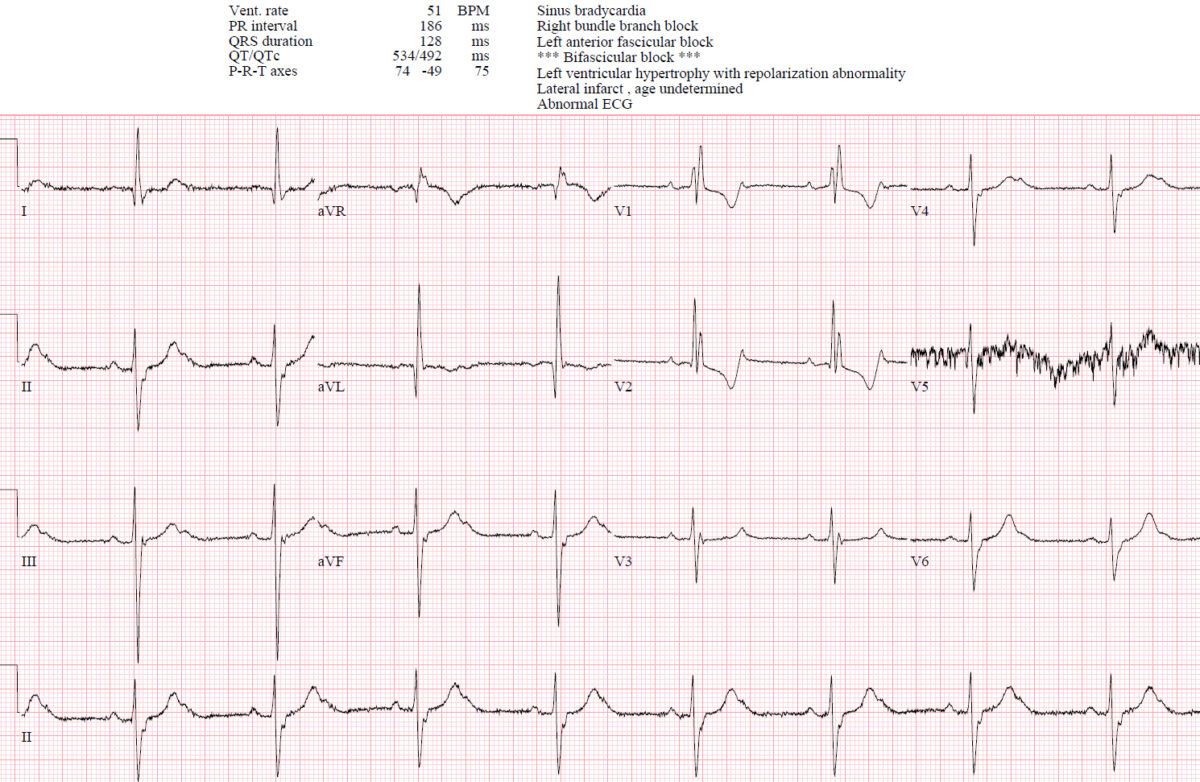 Bradycardia and BRADI Mnemonic | ECG Cases | EM Cases
