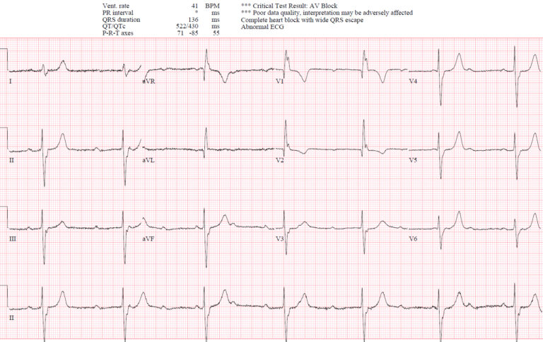 Bradycardia and BRADI Mnemonic | ECG Cases | EM Cases