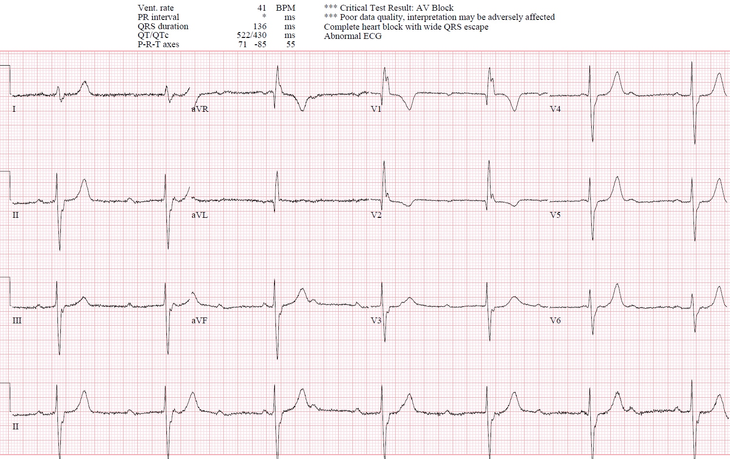 Bradycardia and BRADI Mnemonic | ECG Cases | EM Cases