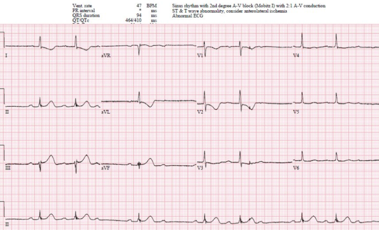 Bradycardia and BRADI Mnemonic | ECG Cases | EM Cases