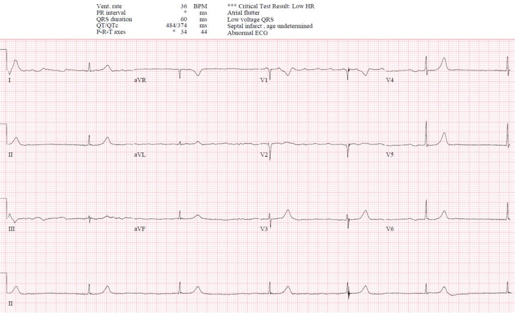 Bradycardia and BRADI Mnemonic | ECG Cases | EM Cases