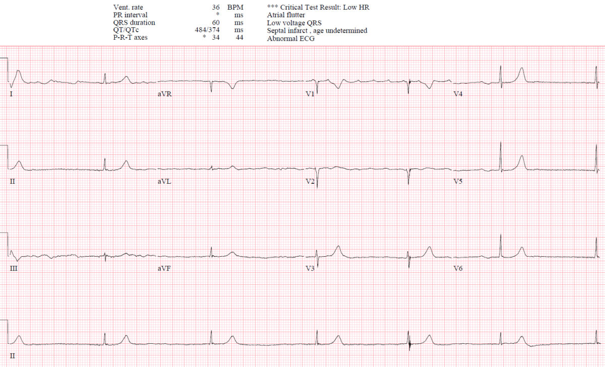 Bradycardia and BRADI Mnemonic | ECG Cases | EM Cases