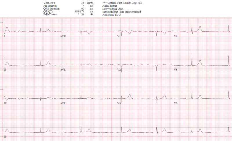 Bradycardia and BRADI Mnemonic | ECG Cases | EM Cases