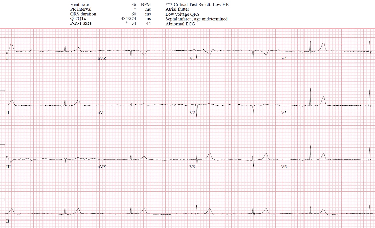Bradycardia and BRADI Mnemonic | ECG Cases | EM Cases