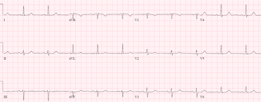 Bradycardia and BRADI Mnemonic | ECG Cases | EM Cases