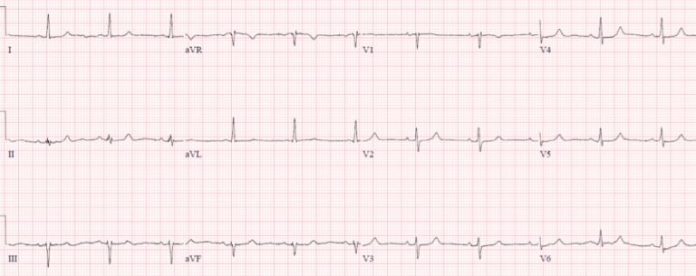 Bradycardia and BRADI Mnemonic | ECG Cases | EM Cases