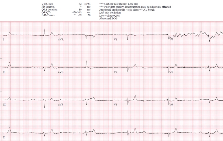 Bradycardia and BRADI Mnemonic | ECG Cases | EM Cases