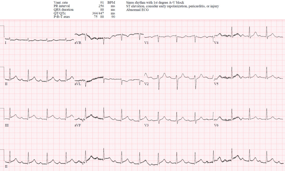 Bradycardia and BRADI Mnemonic | ECG Cases | EM Cases