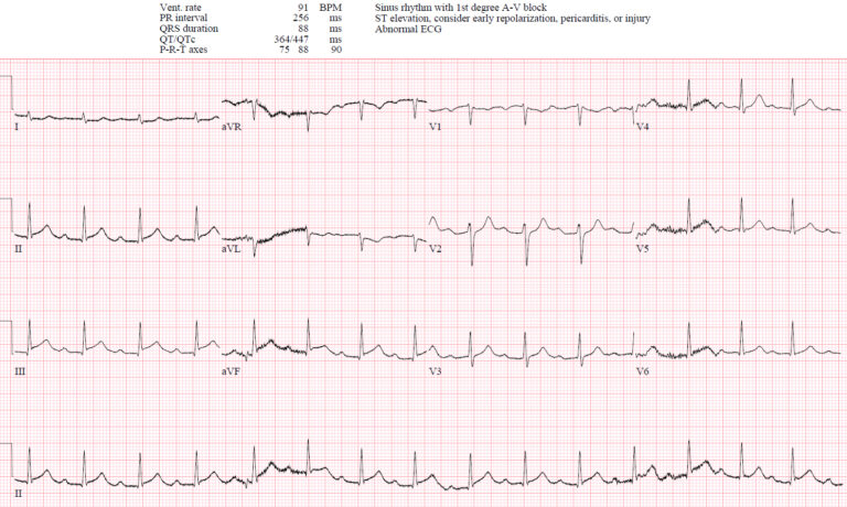 Bradycardia and BRADI Mnemonic | ECG Cases | EM Cases