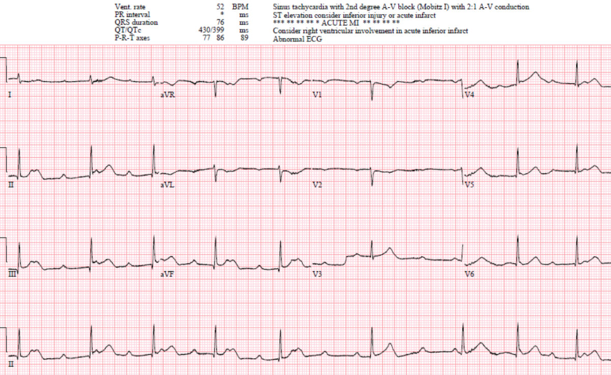 Bradycardia and BRADI Mnemonic | ECG Cases | EM Cases