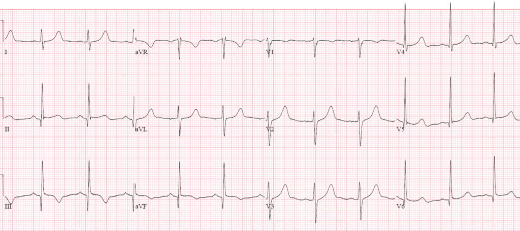 Bradycardia and BRADI Mnemonic | ECG Cases | EM Cases
