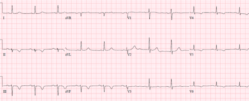 Bradycardia and BRADI Mnemonic | ECG Cases | EM Cases