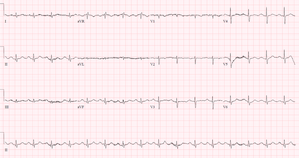 Bradycardia and BRADI Mnemonic | ECG Cases | EM Cases