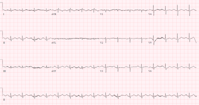 Bradycardia and BRADI Mnemonic | ECG Cases | EM Cases
