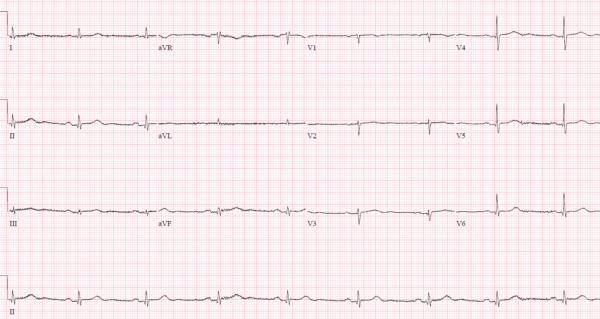 Bradycardia and BRADI Mnemonic | ECG Cases | EM Cases