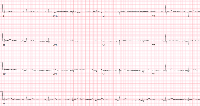Bradycardia and BRADI Mnemonic | ECG Cases | EM Cases