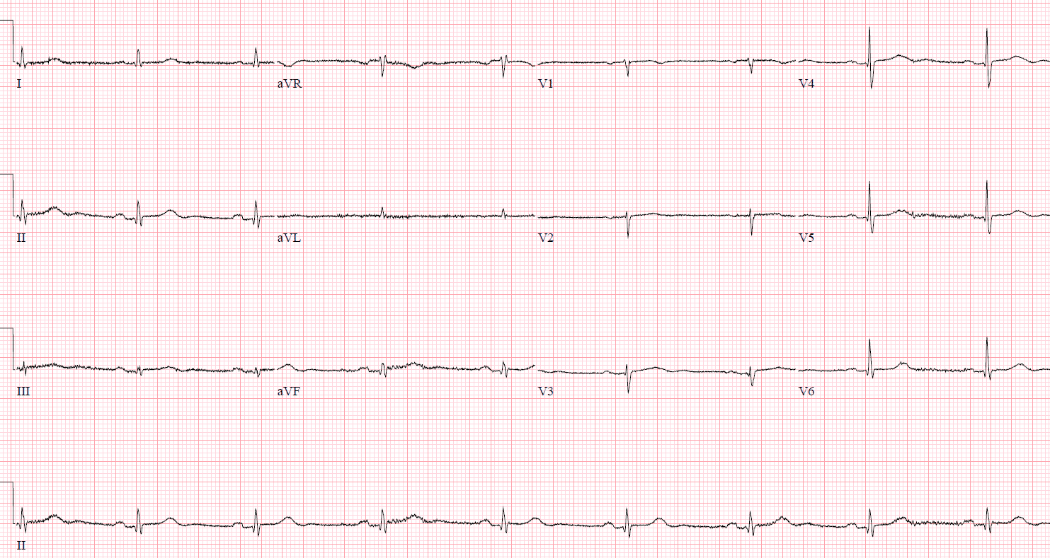 Bradycardia and BRADI Mnemonic | ECG Cases | EM Cases