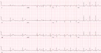 Bradycardia and BRADI Mnemonic | ECG Cases | EM Cases