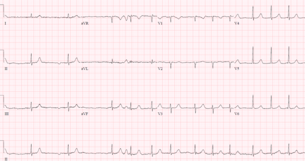 Bradycardia and BRADI Mnemonic | ECG Cases | EM Cases