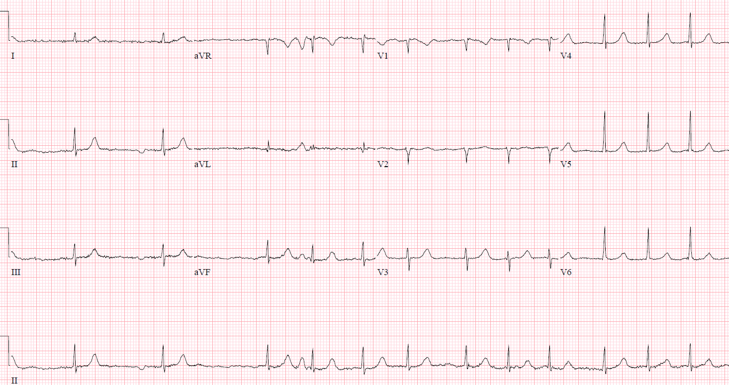 Bradycardia and BRADI Mnemonic | ECG Cases | EM Cases