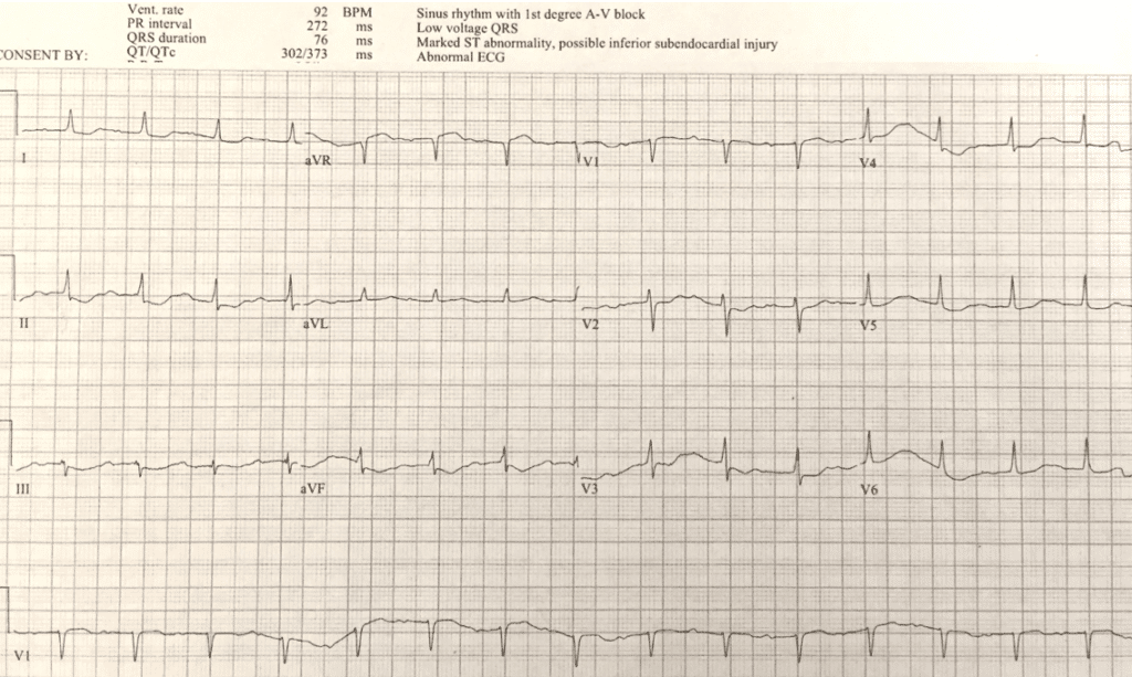 Bradycardia and BRADI Mnemonic | ECG Cases | EM Cases