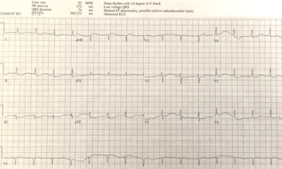 Bradycardia and BRADI Mnemonic | ECG Cases | EM Cases