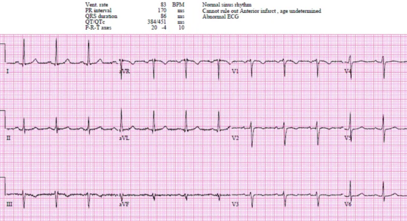 T-wave INVERSION mnemonic | ECG Cases | Emergency Medicine Cases
