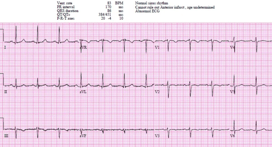 T-wave INVERSION mnemonic | ECG Cases | Emergency Medicine Cases
