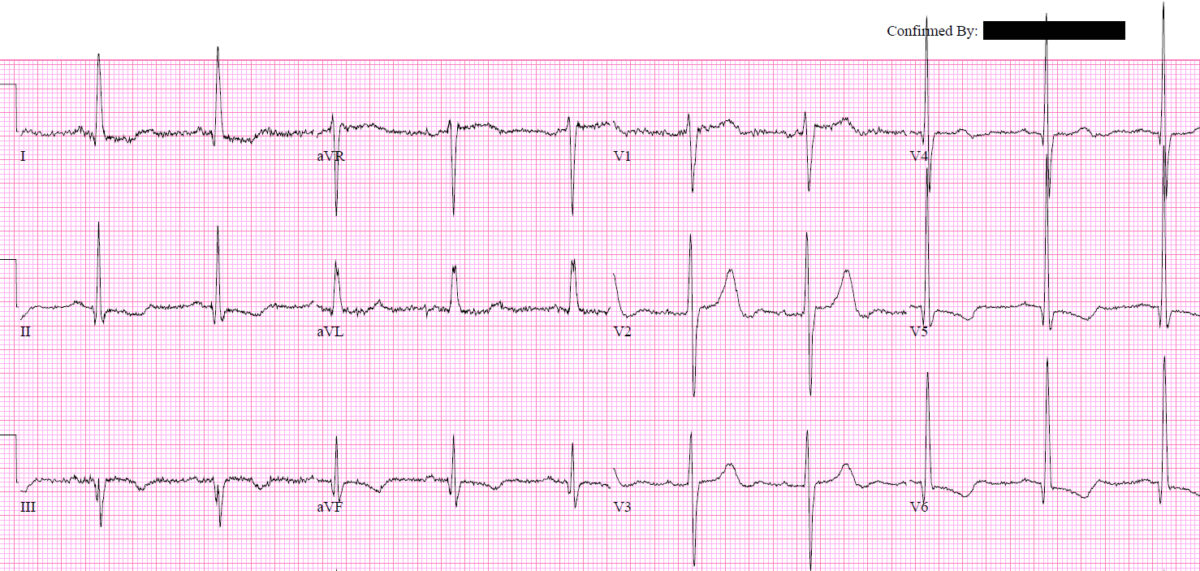 T-wave INVERSION mnemonic | ECG Cases | Emergency Medicine Cases
