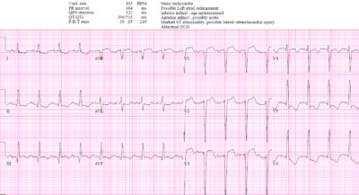 T-wave INVERSION mnemonic | ECG Cases | Emergency Medicine Cases