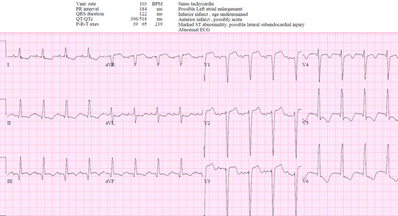 T-wave INVERSION mnemonic | ECG Cases | Emergency Medicine Cases