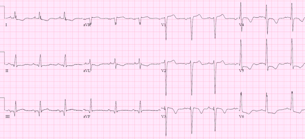 T-wave INVERSION mnemonic | ECG Cases | Emergency Medicine Cases
