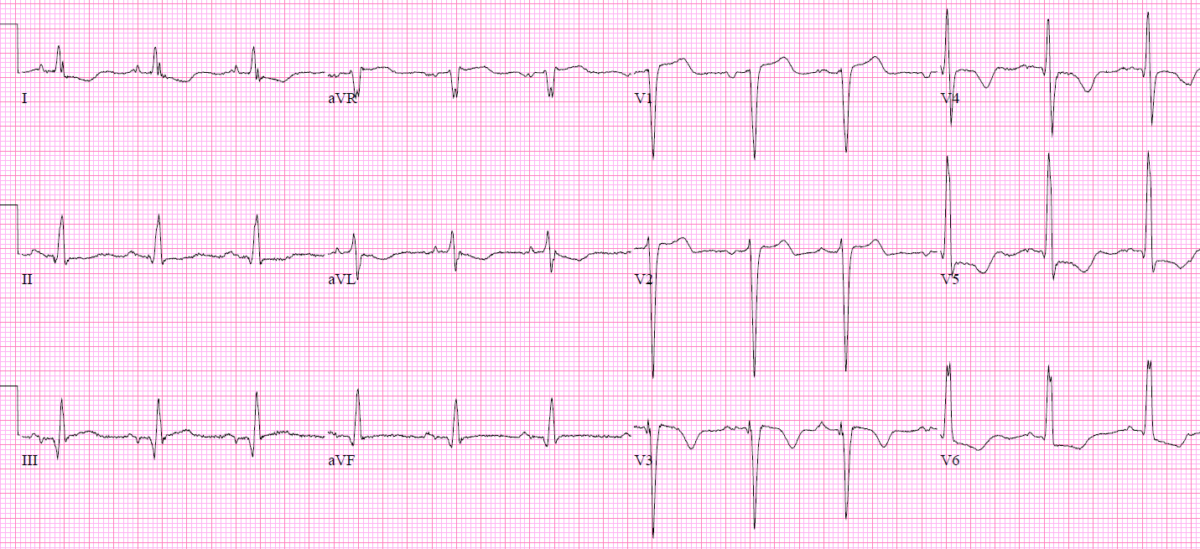 T-wave INVERSION mnemonic | ECG Cases | Emergency Medicine Cases