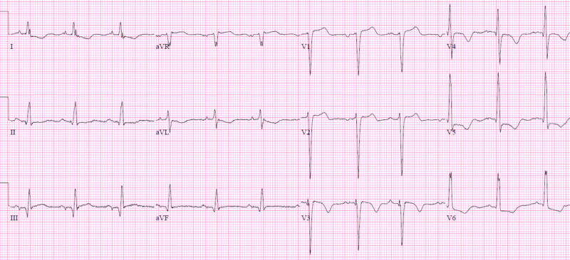 T-wave INVERSION mnemonic | ECG Cases | Emergency Medicine Cases