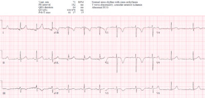 T-wave INVERSION mnemonic | ECG Cases | Emergency Medicine Cases