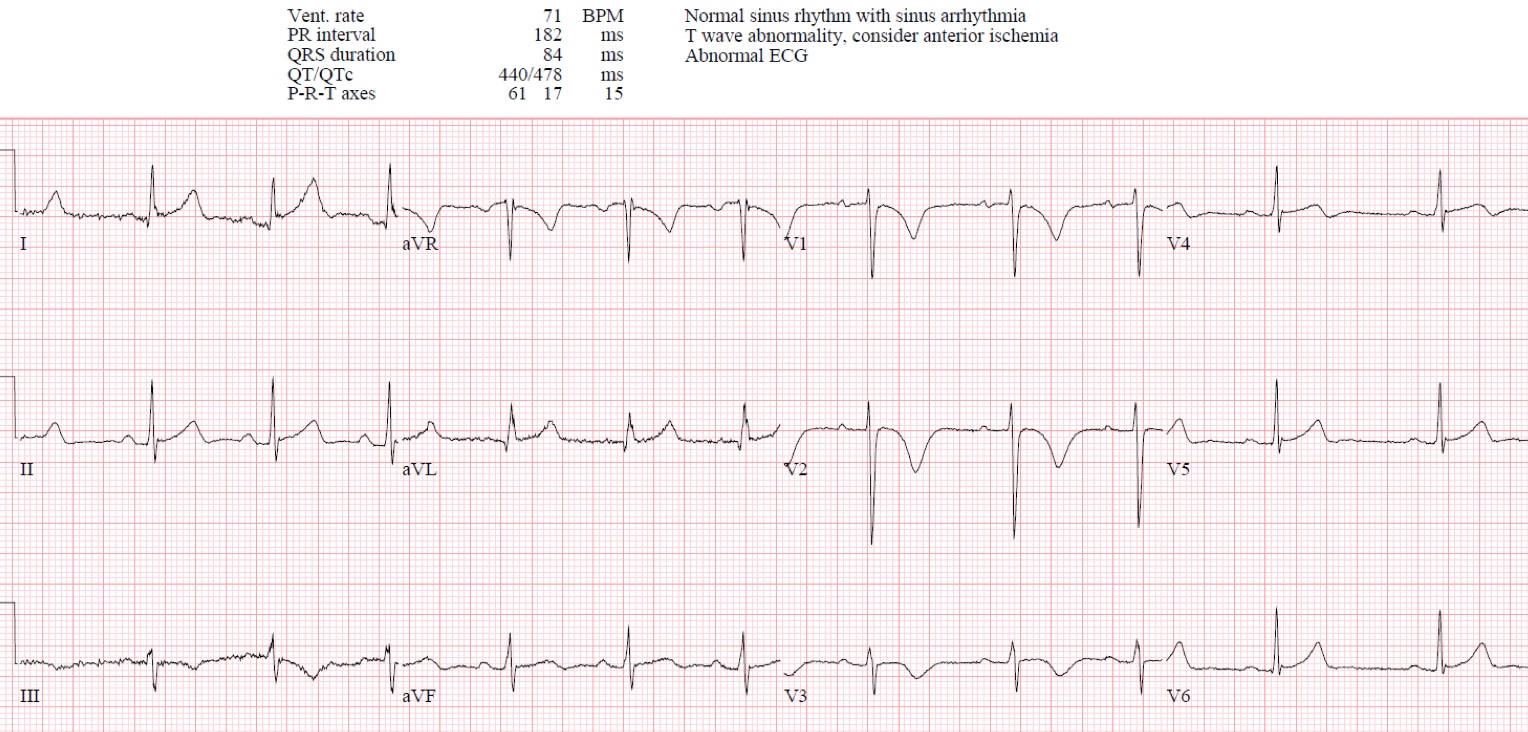 T-wave INVERSION mnemonic | ECG Cases | Emergency Medicine Cases