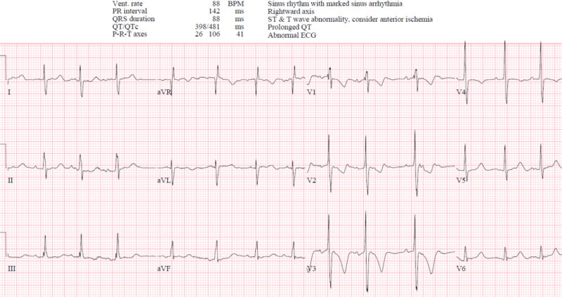 T-wave INVERSION mnemonic | ECG Cases | Emergency Medicine Cases