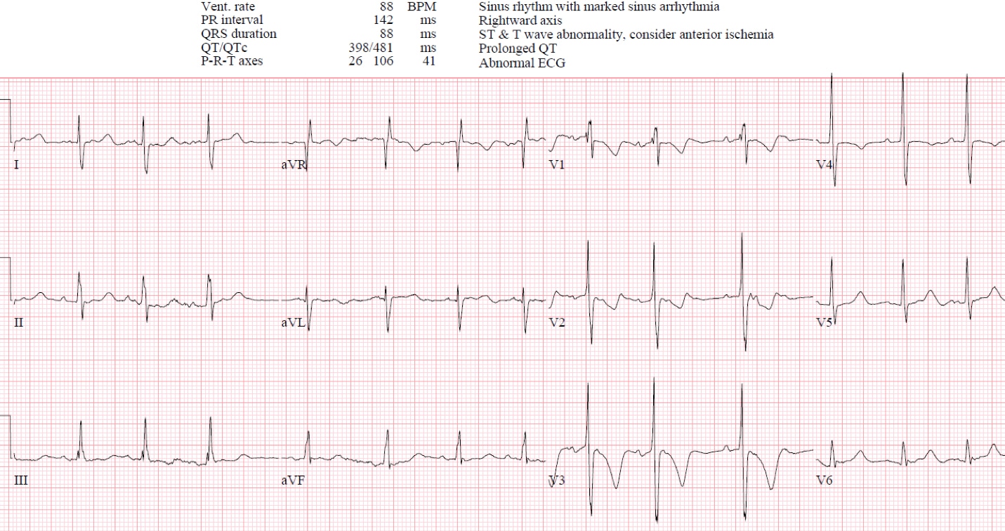 T-wave INVERSION mnemonic | ECG Cases | Emergency Medicine Cases