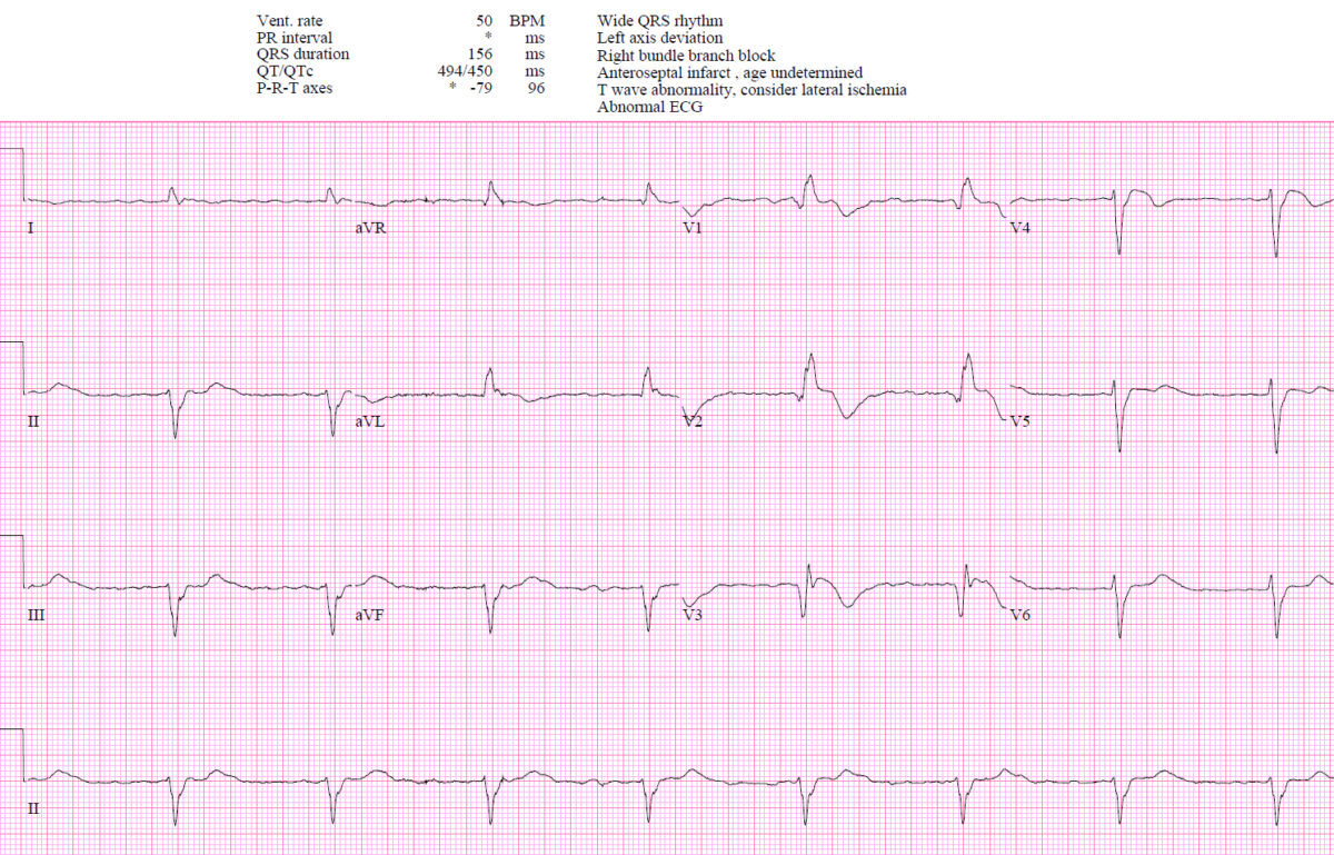 T-wave INVERSION mnemonic | ECG Cases | Emergency Medicine Cases
