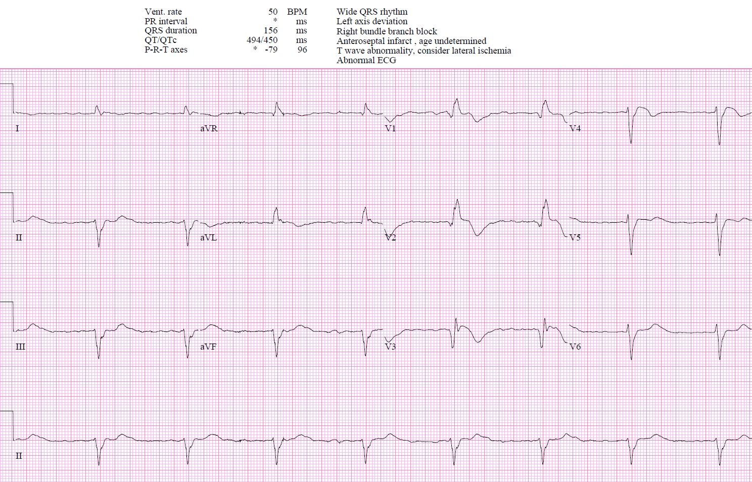 T-wave INVERSION mnemonic | ECG Cases | Emergency Medicine Cases
