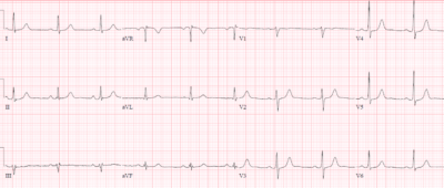 T-wave INVERSION mnemonic | ECG Cases | Emergency Medicine Cases