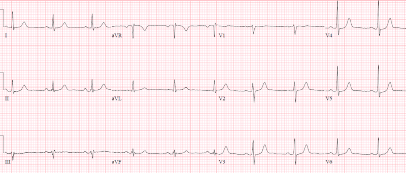 T-wave INVERSION mnemonic | ECG Cases | Emergency Medicine Cases