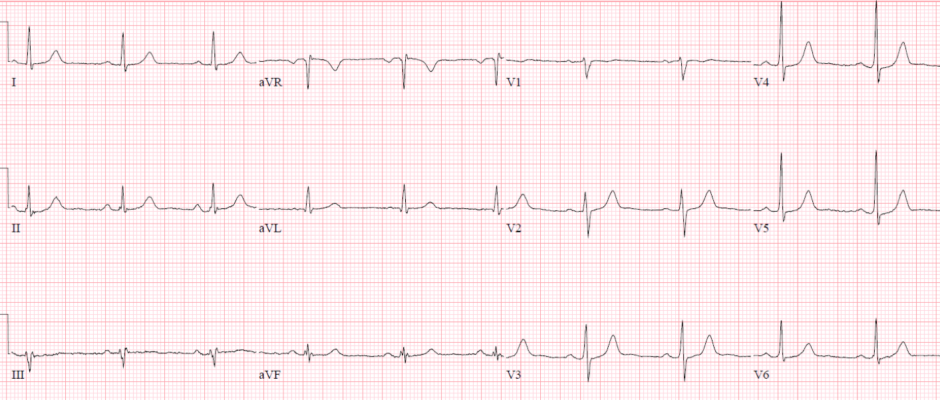 T-wave INVERSION mnemonic | ECG Cases | Emergency Medicine Cases