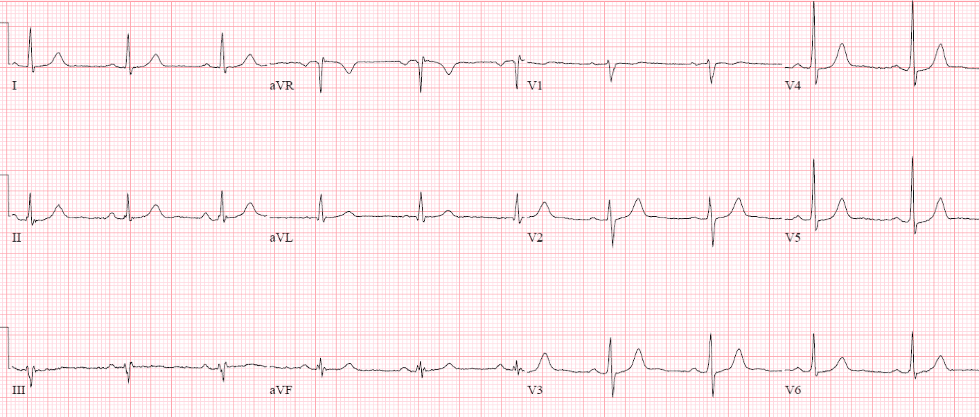 T-wave INVERSION mnemonic | ECG Cases | Emergency Medicine Cases
